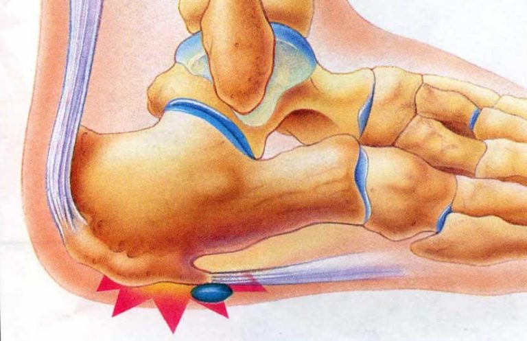 Dolor del Talón o Talalgia - Consulta Médica del Dolor GranadaCentro ...