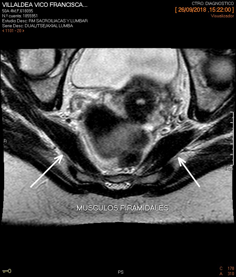Síndrome Piramidal o Piriforme, síntomas y tratamiento. - Consulta ...