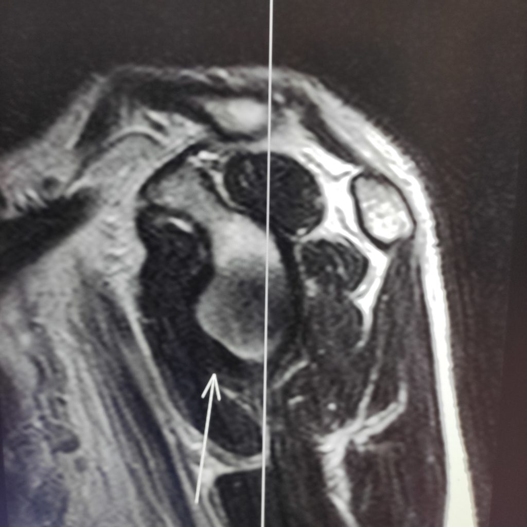Capsulitis Adhesiva síntomas y tratamiento. - Consulta Médica del Dolor ...