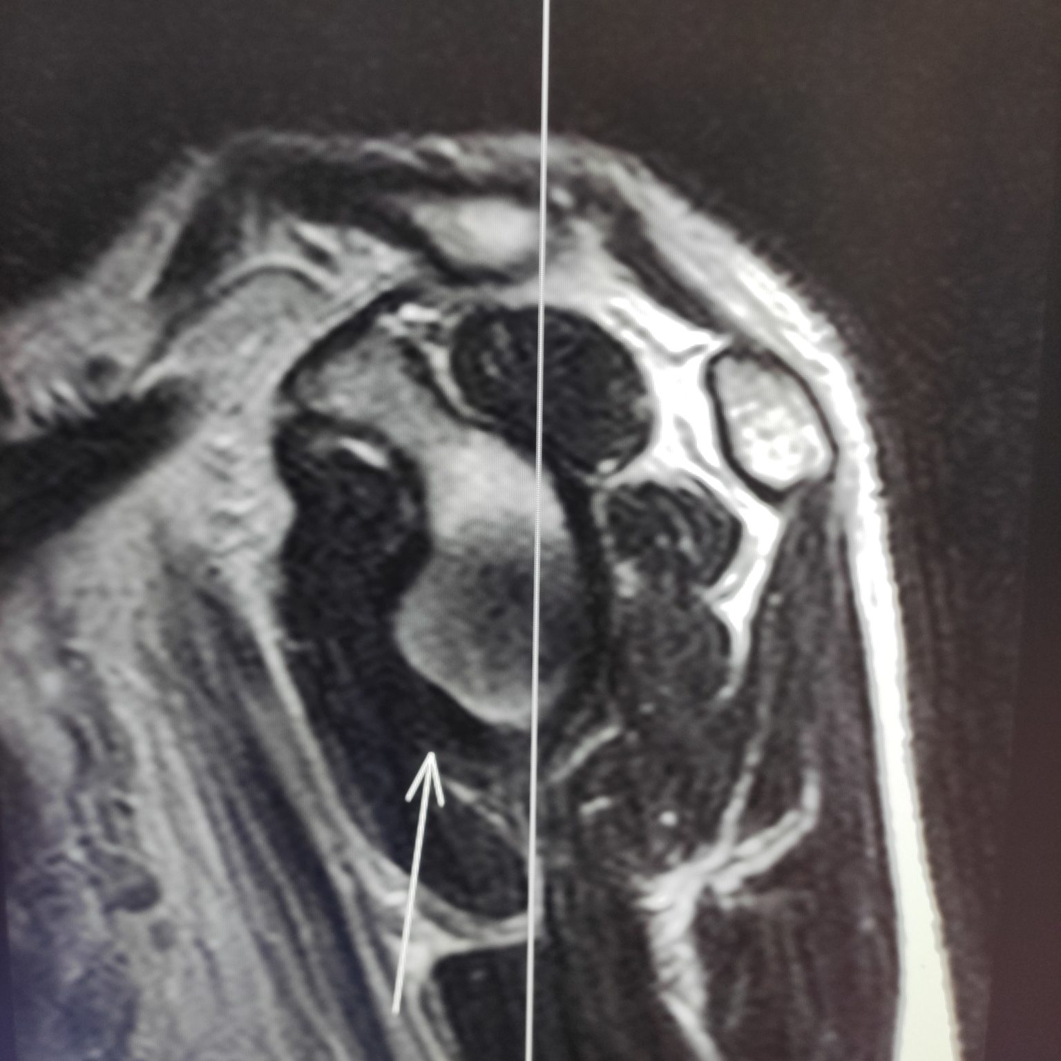 Capsulitis Adhesiva síntomas y tratamiento. - Consulta Médica del Dolor ...
