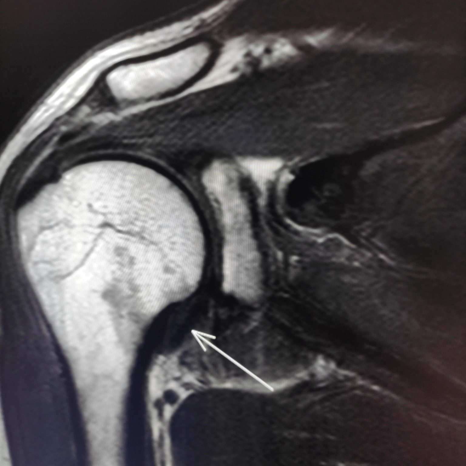 Capsulitis Adhesiva síntomas y tratamiento. - Consulta Médica del Dolor ...