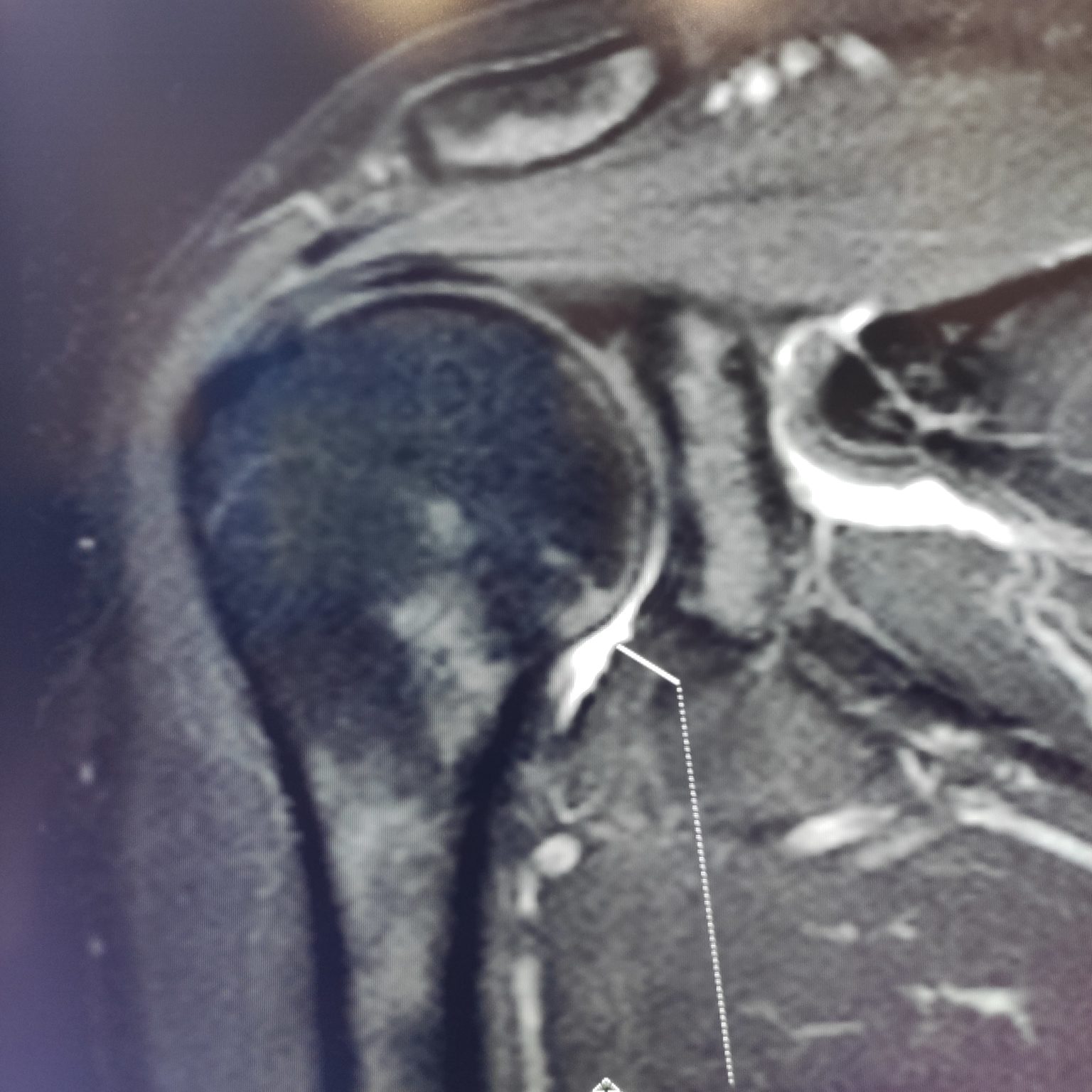 Capsulitis Adhesiva síntomas y tratamiento. - Consulta Médica del Dolor ...