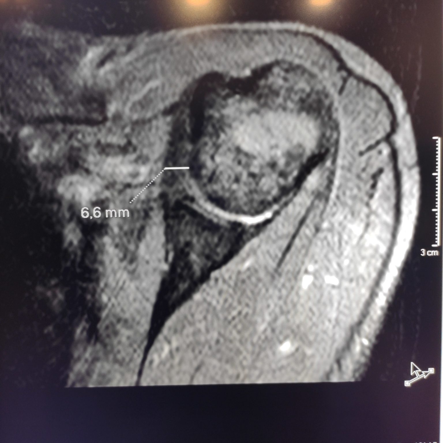 Capsulitis Adhesiva síntomas y tratamiento. - Consulta Médica del Dolor ...